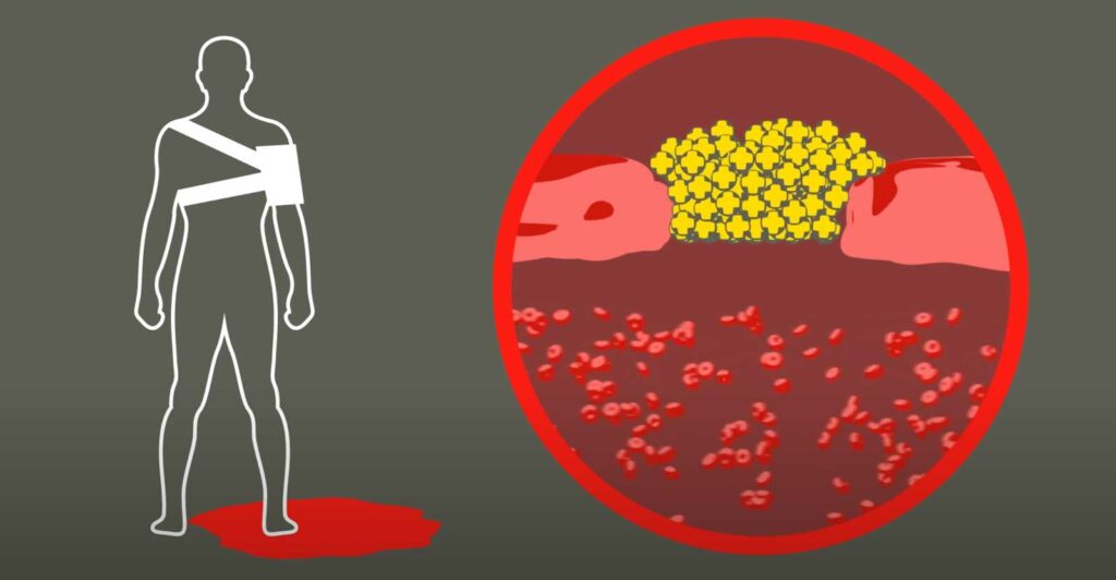 Celox Gauze helps save lives in emergency bleeding injuries